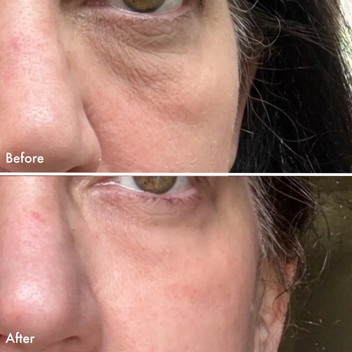 At-Home Skincare Lasers | Skin-Tightening Facial Lasers | NIRA