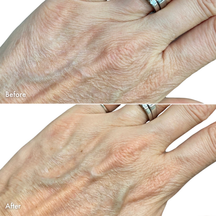 At-Home Skincare Lasers | Skin-Tightening Facial Lasers | NIRA