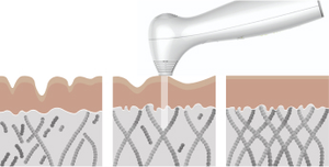 How NIRA Lasers Work | NIRA's Non-Fractional Laser Technology