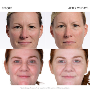 NIRA Pro Laser | At-Home Laser Device for Full Wrinkle Reduction