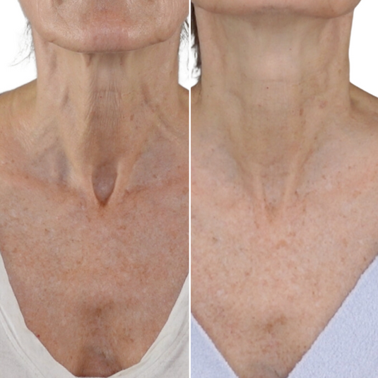 NIRA's Before & After At-Home Laser Results | NIRA Reviews