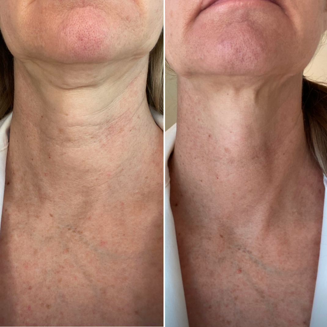 NIRA's Before & After At-Home Laser Results | NIRA Reviews